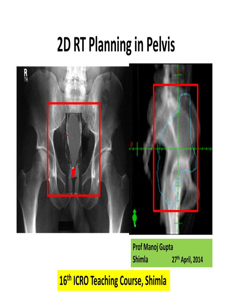 Emailing 11. Dr. Manoj Gupta - Pelvic RT Planning | PDF | Pelvis | Uterus