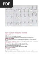 Delta Wave in WPW Syndrome Explained | PDF | Cardiac Electrophysiology ...