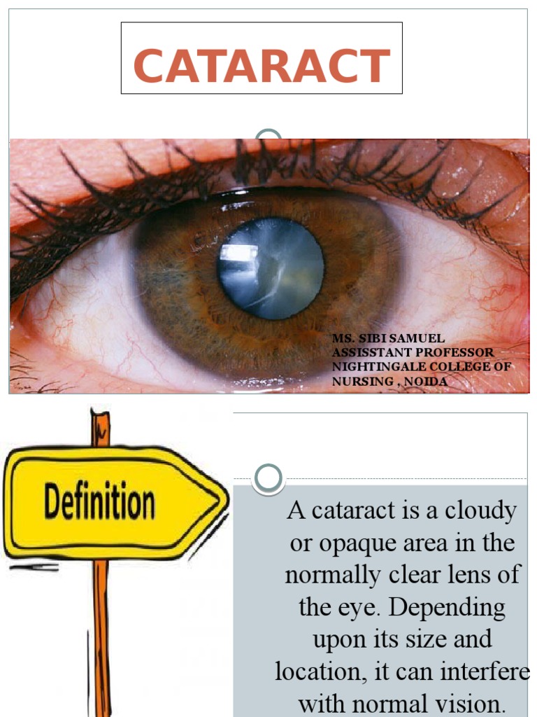 Cataract PPT Final | PDF | Cataract | Ophthalmology