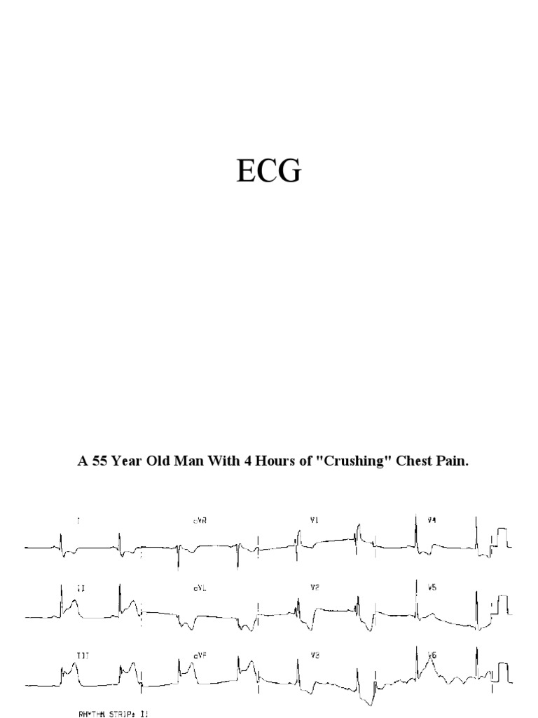 ECG For Osce | PDF | Electrocardiography | Heart