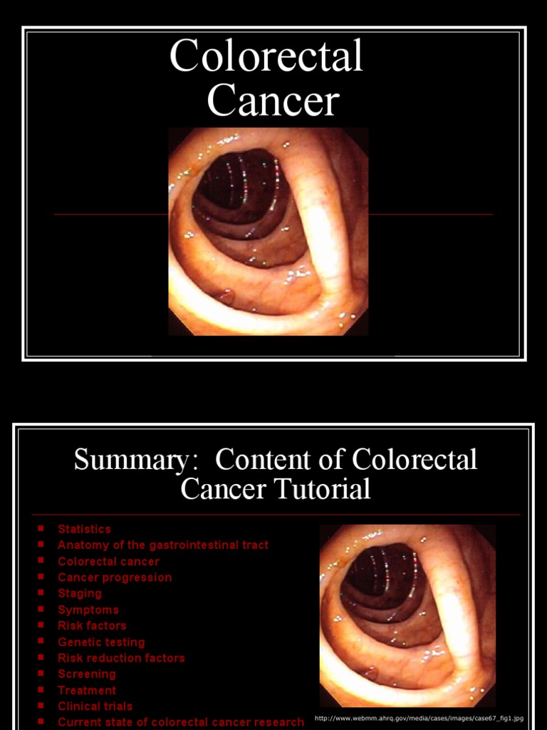 Colon Cancer | PDF | Colorectal Cancer | Colonoscopy