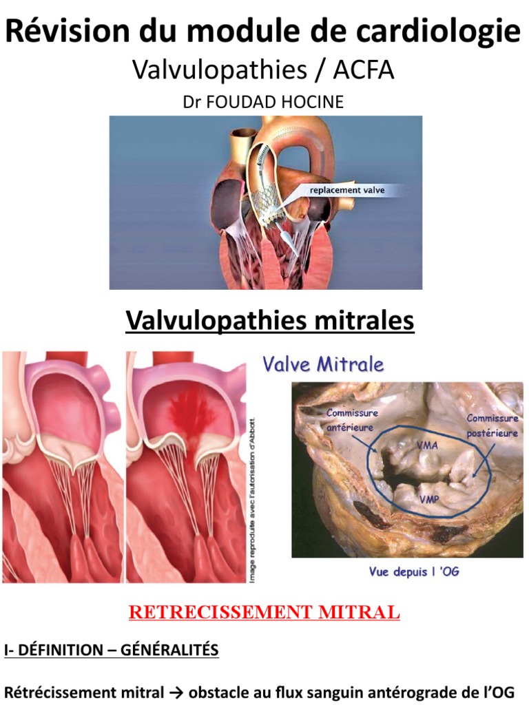 Valvulopathies Acfa | PDF | Insuffisance cardiaque | Aorte