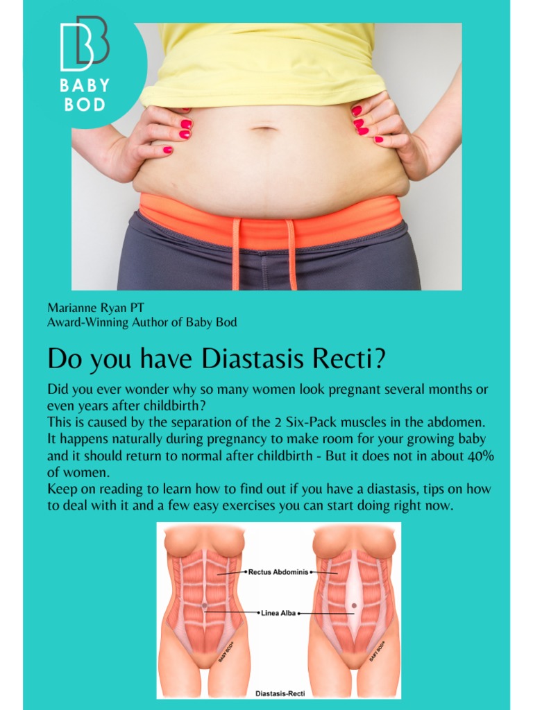 Diastasis Recti Information - Marianne Ryan - Baby-Bod-2019 | PDF ...