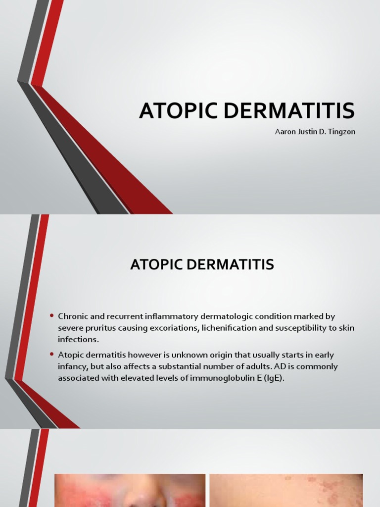 Atopic Dermatitis: Aaron Justin D. Tingzon | PDF | Dermatitis | Allergy