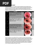 Clasificación del Combe en Tuberculosis | PDF
