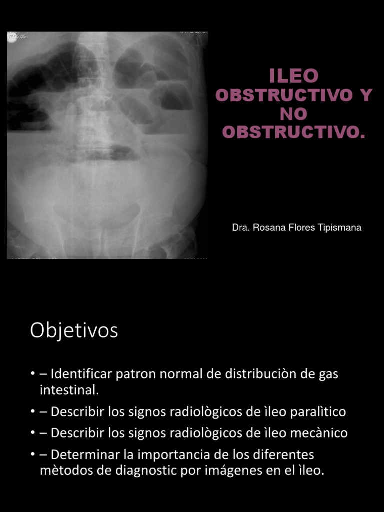 Clase Ileo Obstructivo y No Obstructivo | PDF | Intestino grueso | Abdomen