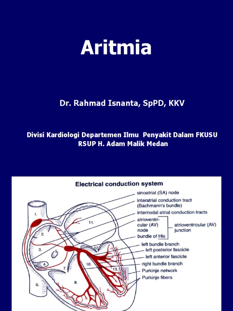 EKG Aritmia | PDF