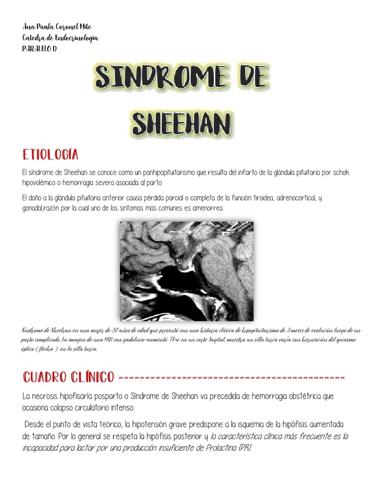 Comprehensive overview of Sheehan's syndrome including etiology ...