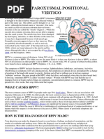 Gufoni Maneuver for Lateral Canal BPPV | PDF | Nervous System ...