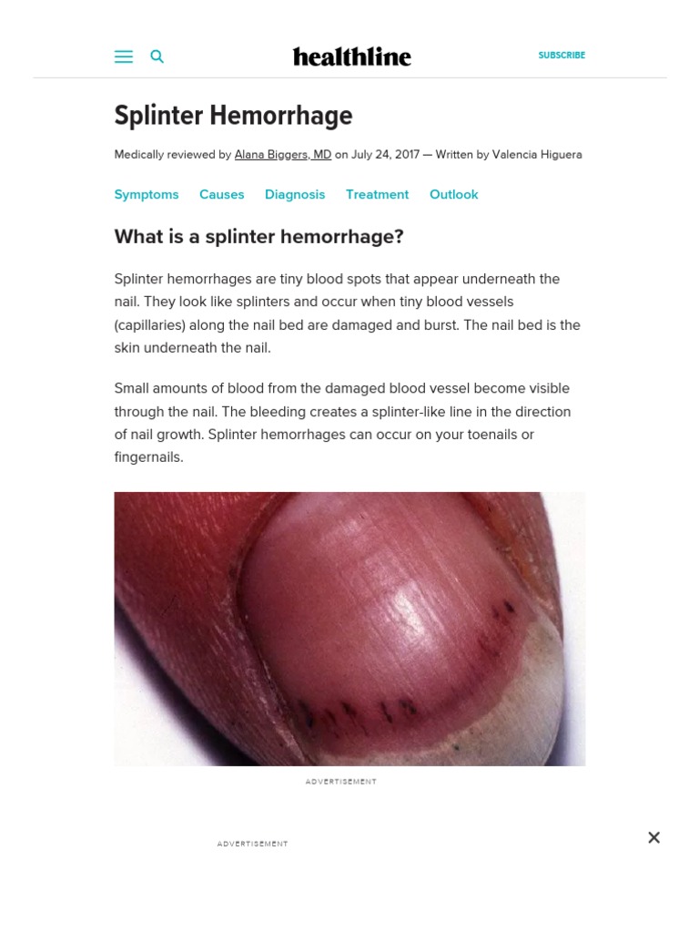Splinter Hemorrhages - Symptoms, Causes, and Treatments PDF | PDF ...