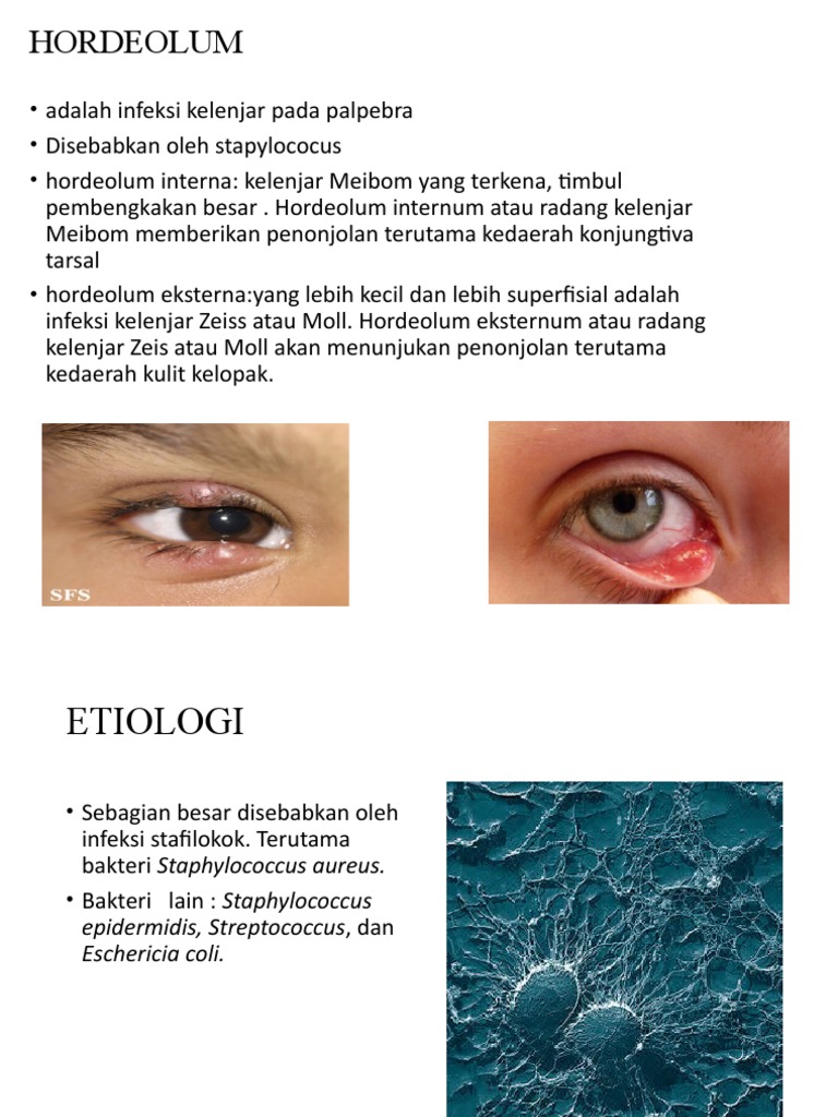 Hordeolum PPT DR | PDF