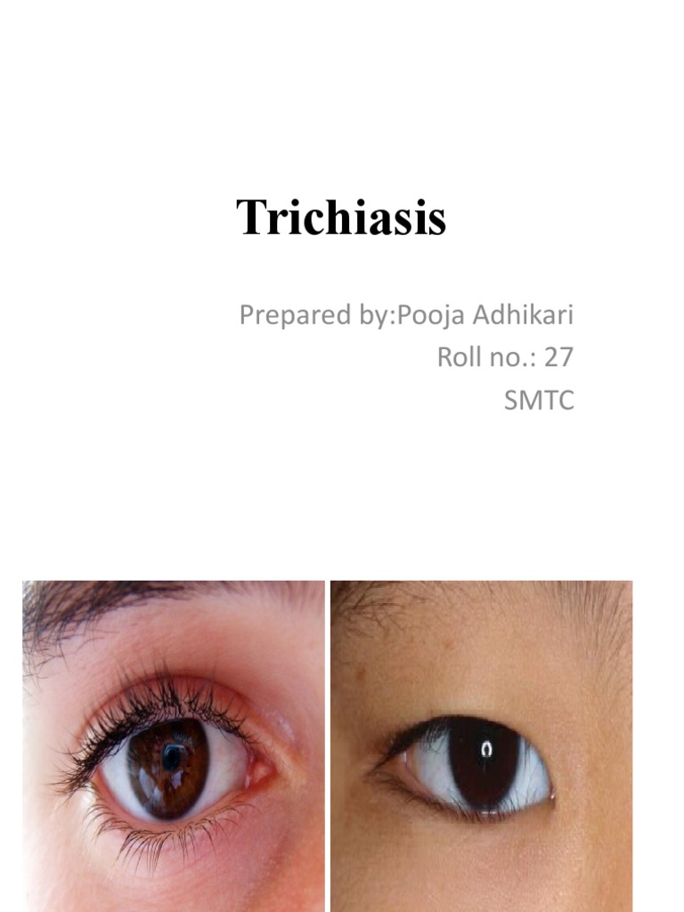 Trichiasis: Prepared By:pooja Adhikari Roll No.: 27 SMTC | PDF | Pain ...