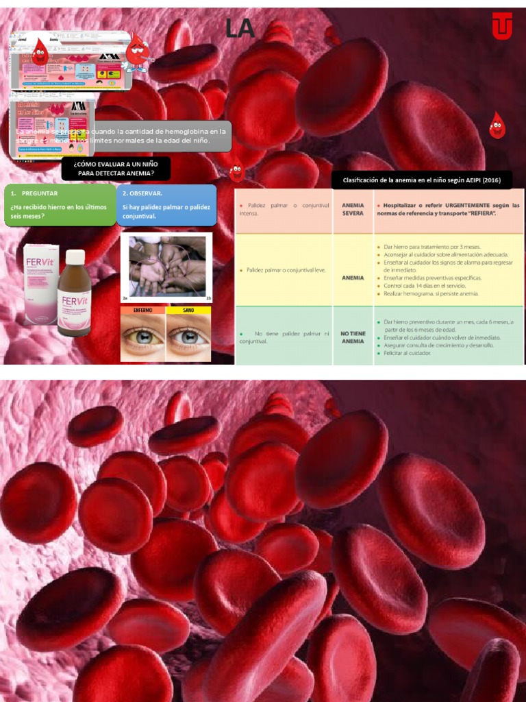 Anemia. Infografia | PDF
