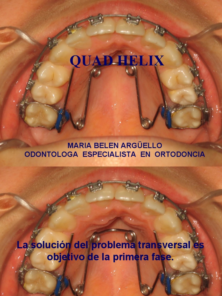 Quad Helix | PDF | Ortodoncia | Bienestar