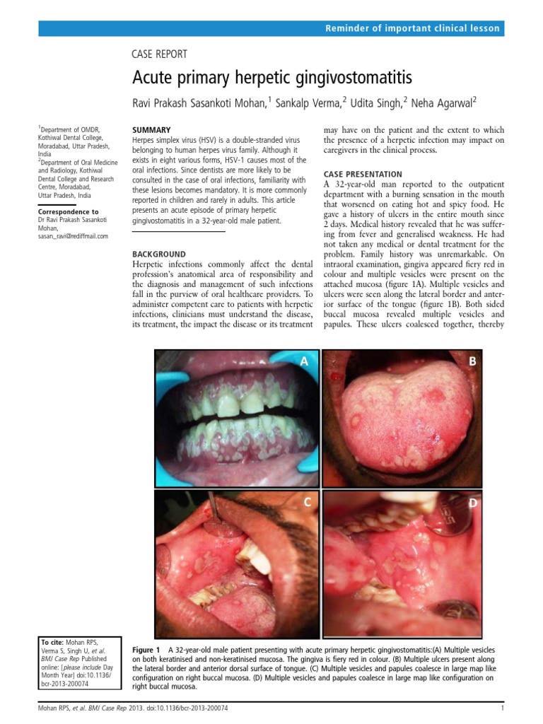 Acute Primary Herpetic Gingivostomatitis: Ravi Prakash Sasankoti Mohan ...