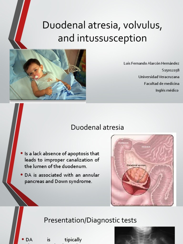 Duodenal Atresia, Volvulus, and Intussusception | PDF | Digestive ...