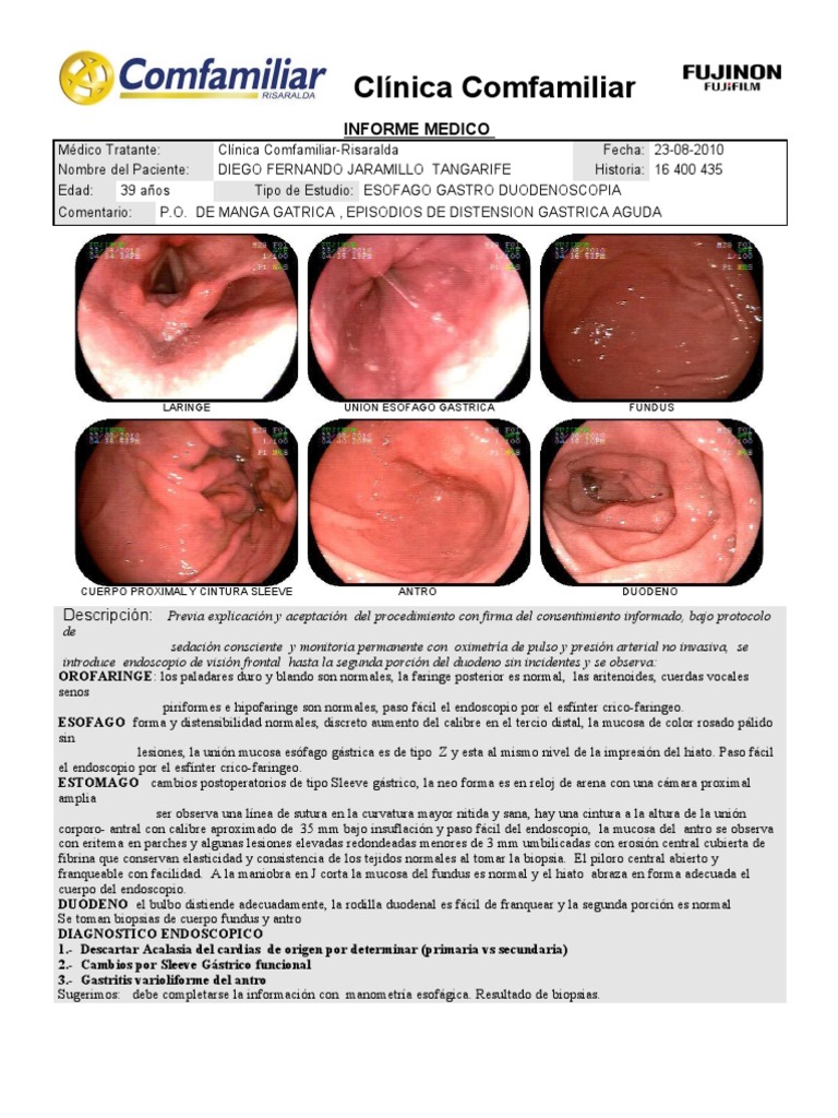 Gastritis Varioliforme en Antro Gástrico | PDF | Endoscopia | Estómago