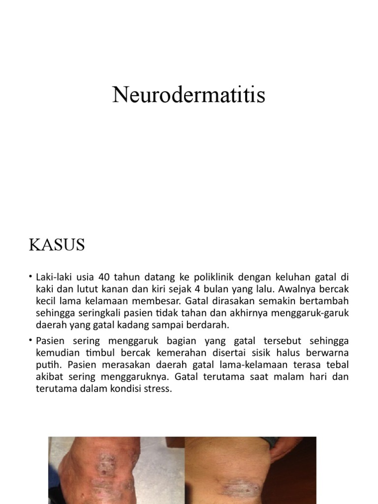 Neurodermatitis: Gejala dan Penanganan | PDF | Kesehatan Holistik ...