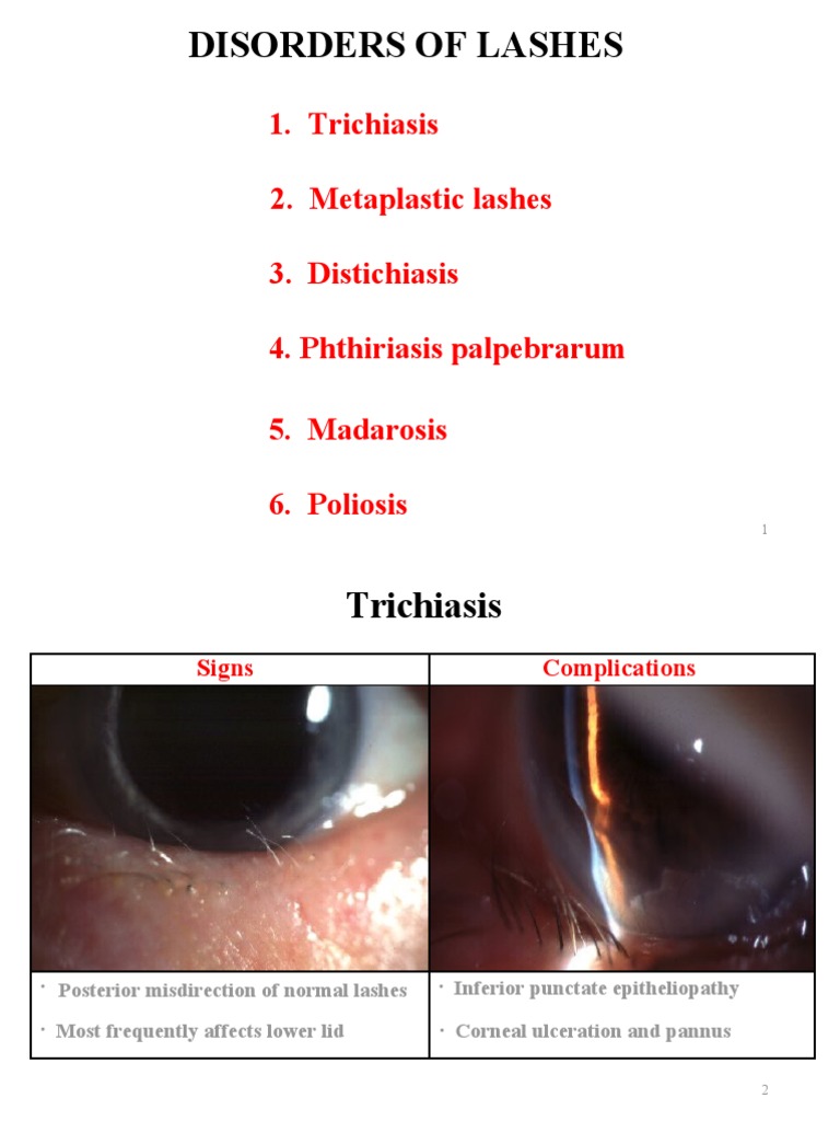 Disorders of Lashes: 1. Trichiasis 2. Metaplastic Lashes 3 ...