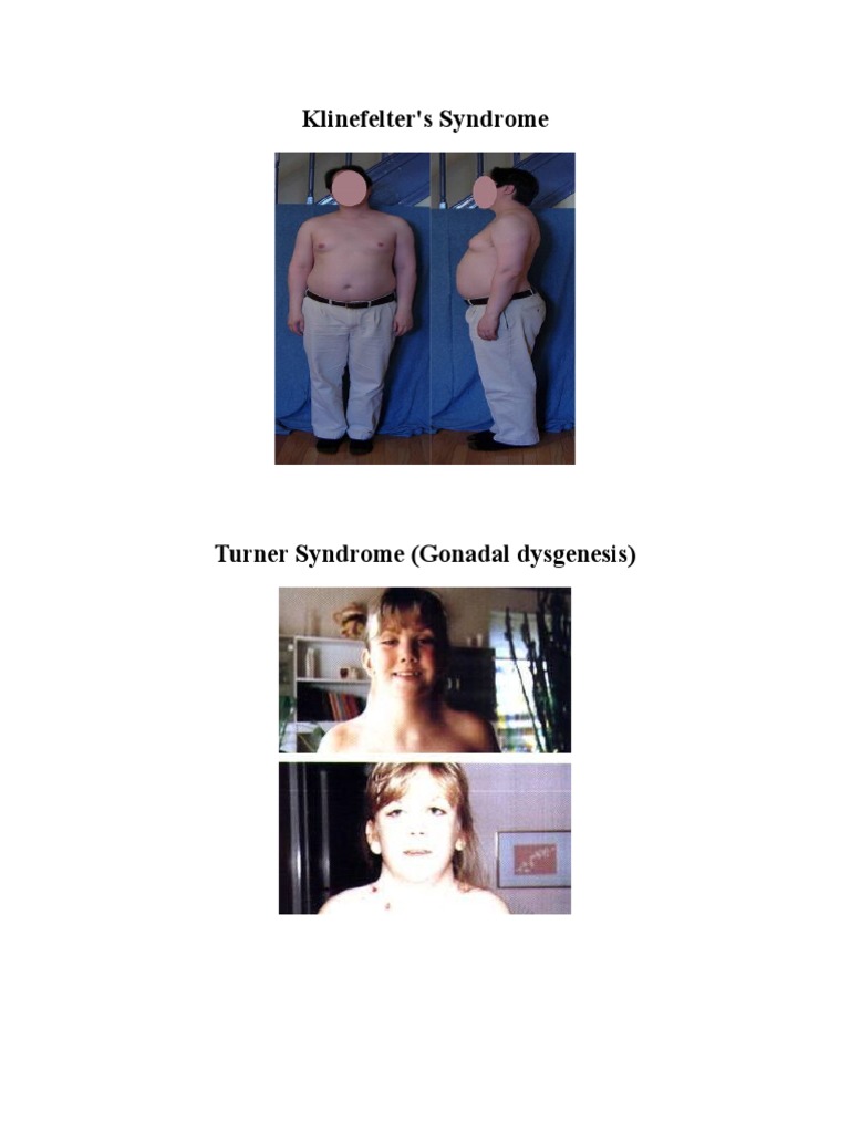 Klinefelter's Syndrome Overview | PDF
