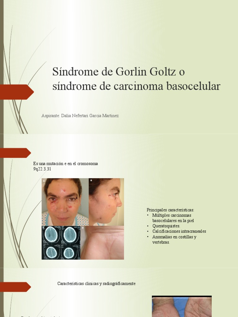 Síndrome de Gorlin Goltz o Síndrome de Carcinoma | PDF