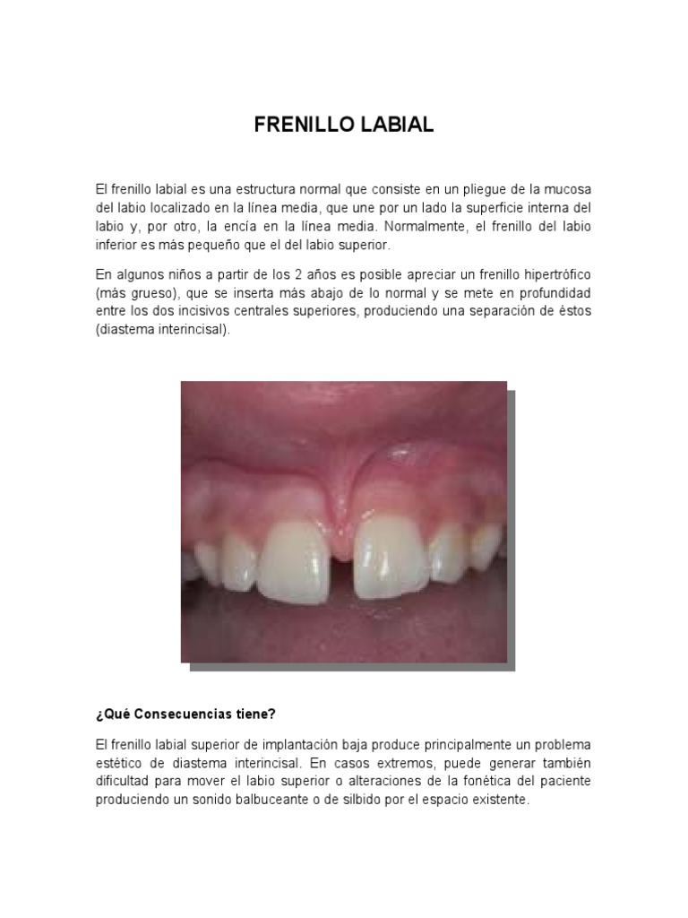 Frenillo labial: Consecuencias y cirugía | PDF | Dentadura postiza ...
