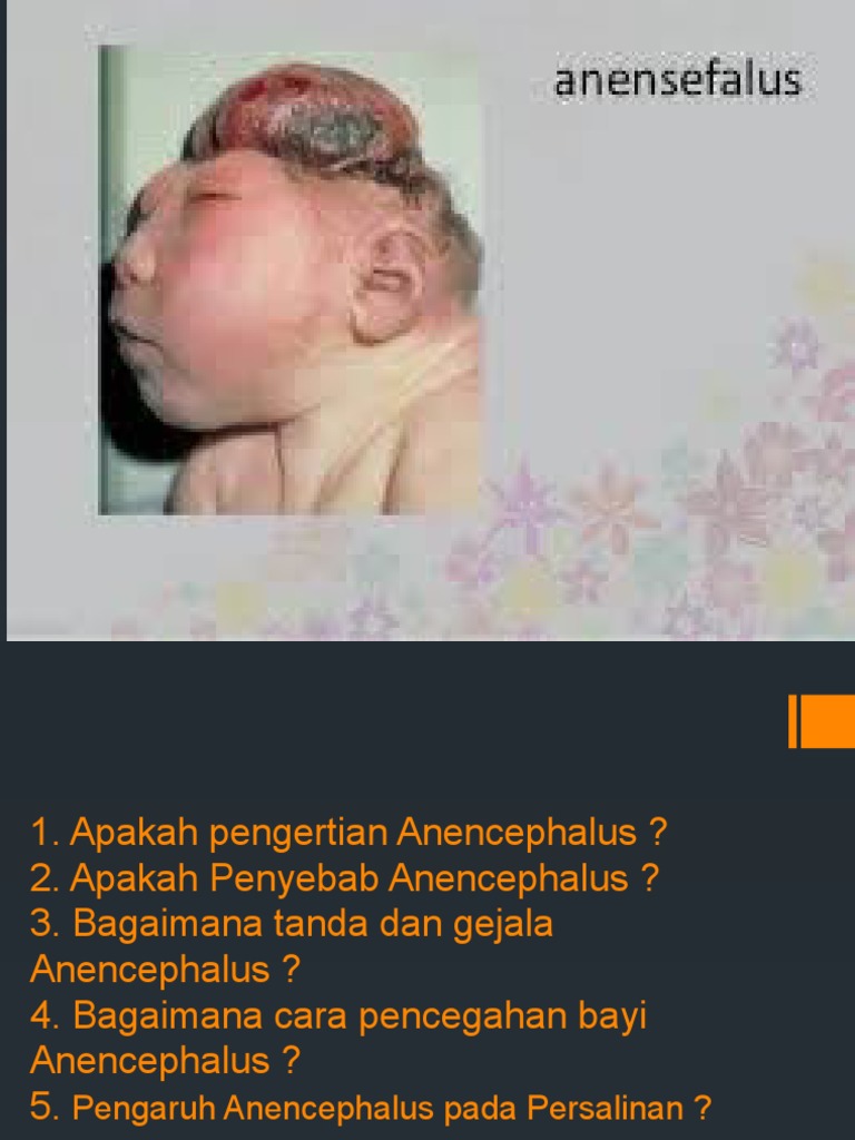 Anensefalus | PDF | Sains & Matematika