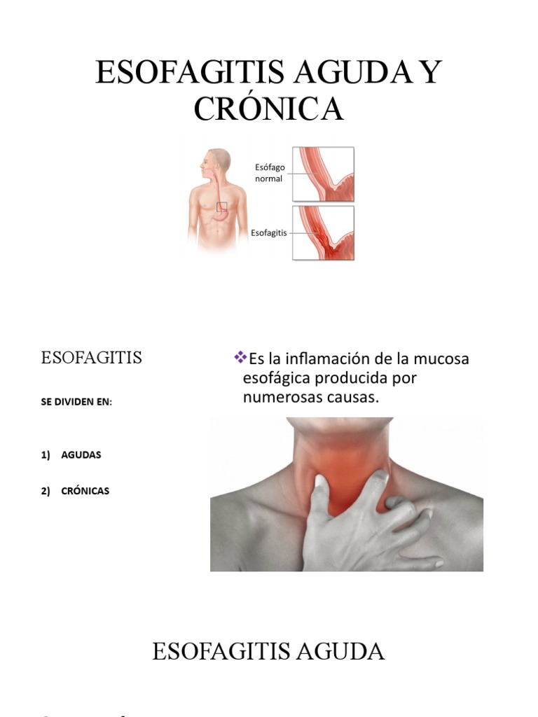 Esofagitis Aguda y Crónica | PDF | La enfermedad por reflujo ...