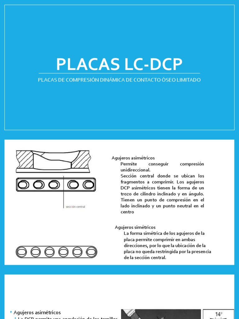 Placas LC-DCP | PDF | Tornillo | Rigidez