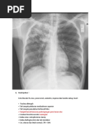 Anatomi Thorax Normal + Gambaran Radiologi | PDF