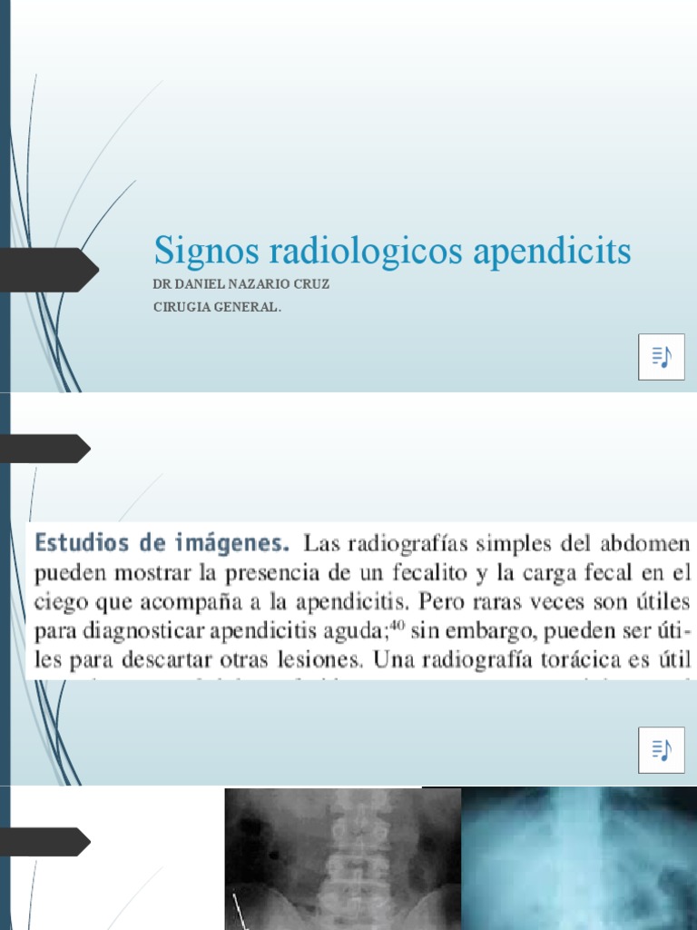 Signos Radiologicos de Apendicitis | PDF