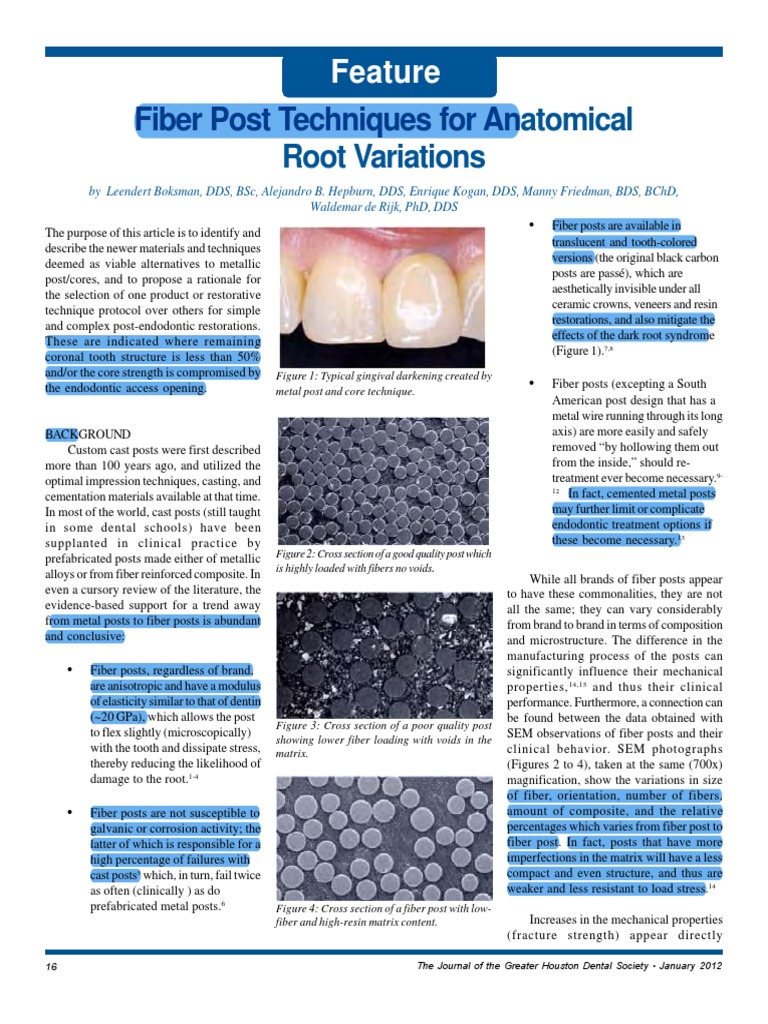 Fiber Post Techniques For Anatomical Root Variations: Feature | PDF ...