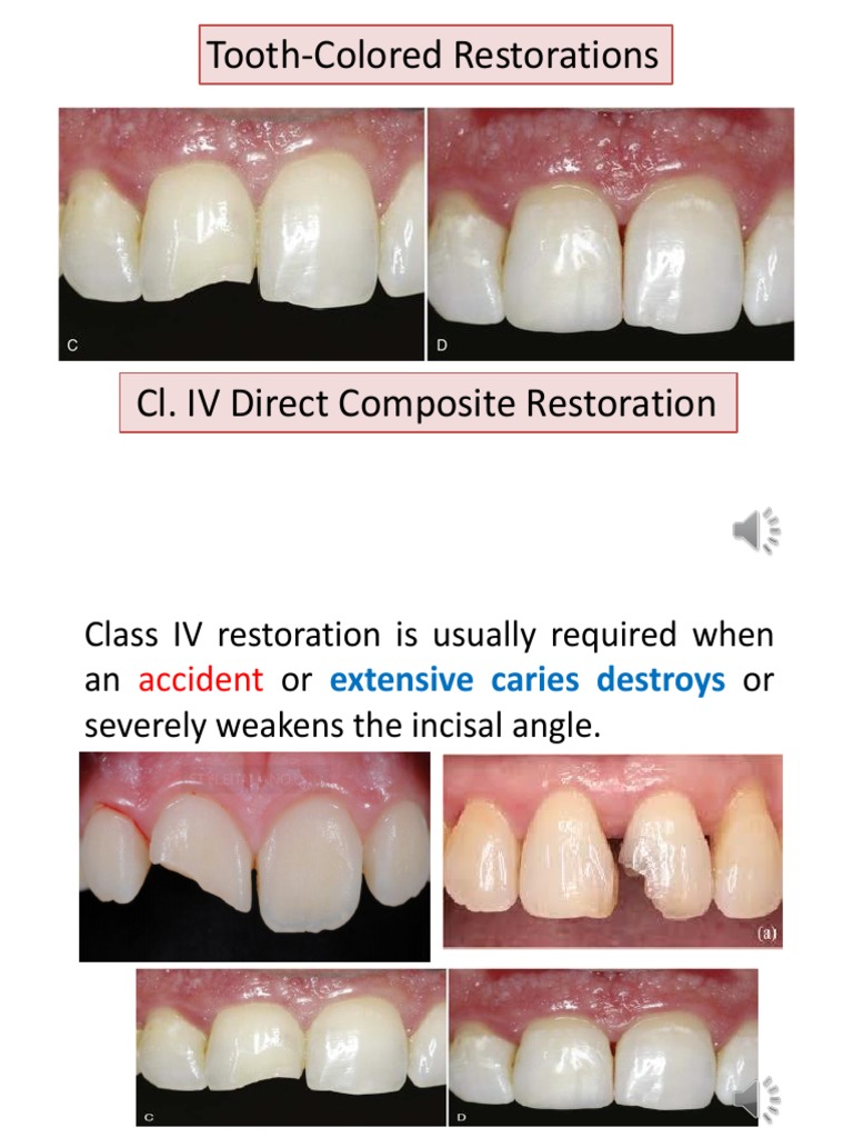 Class IV Composite Restoration Techniques | PDF | Composite Material ...