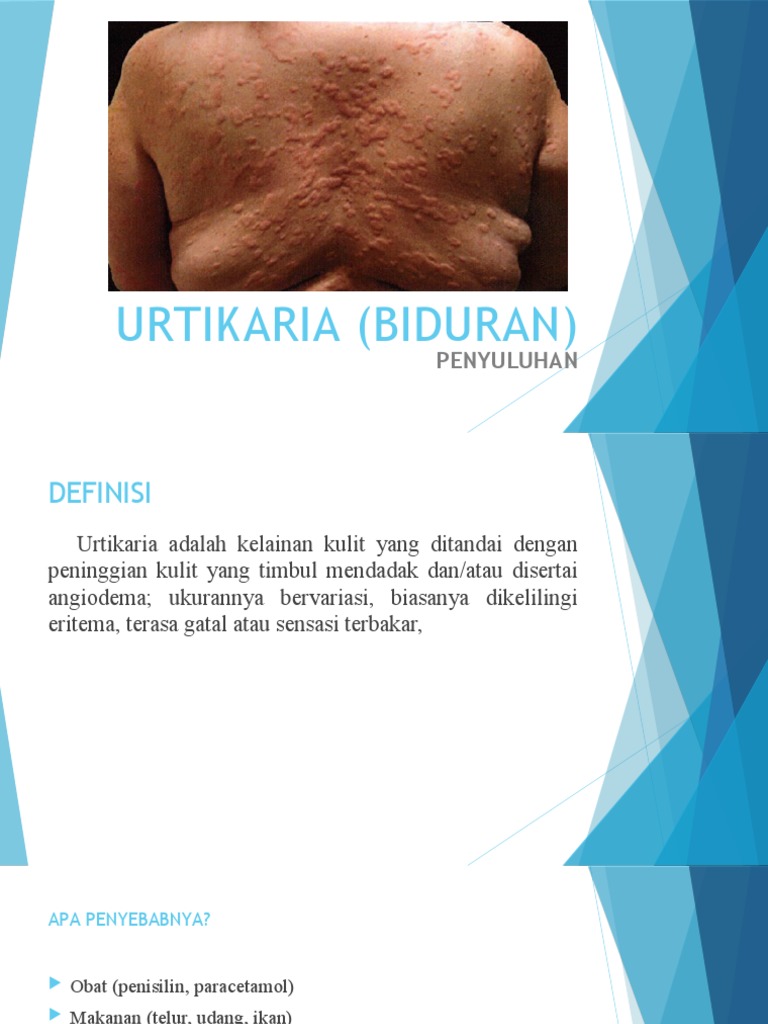 Urtikaria (Biduran) | PDF