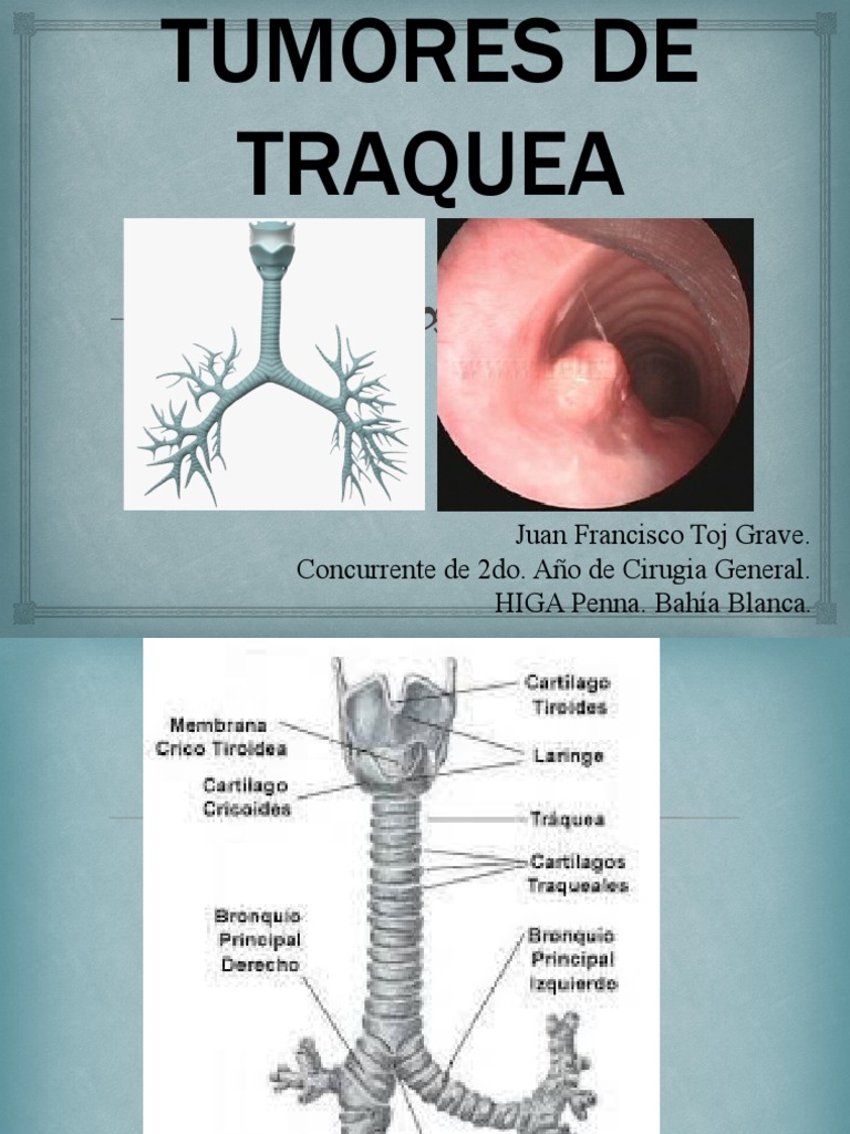 Tumores Traqueales: Tipos y Tratamiento | PDF | Neoplasias | Tumor benigno