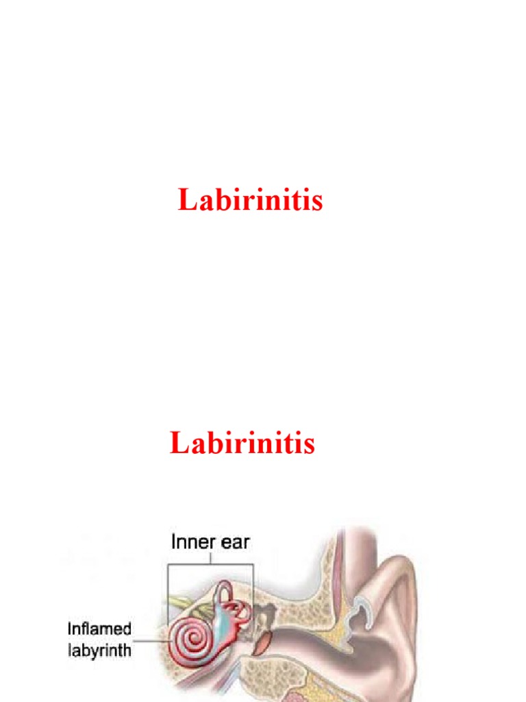 Labirinitis | PDF