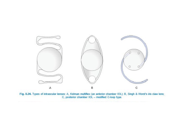 Types of Intraocular Lenses | PDF