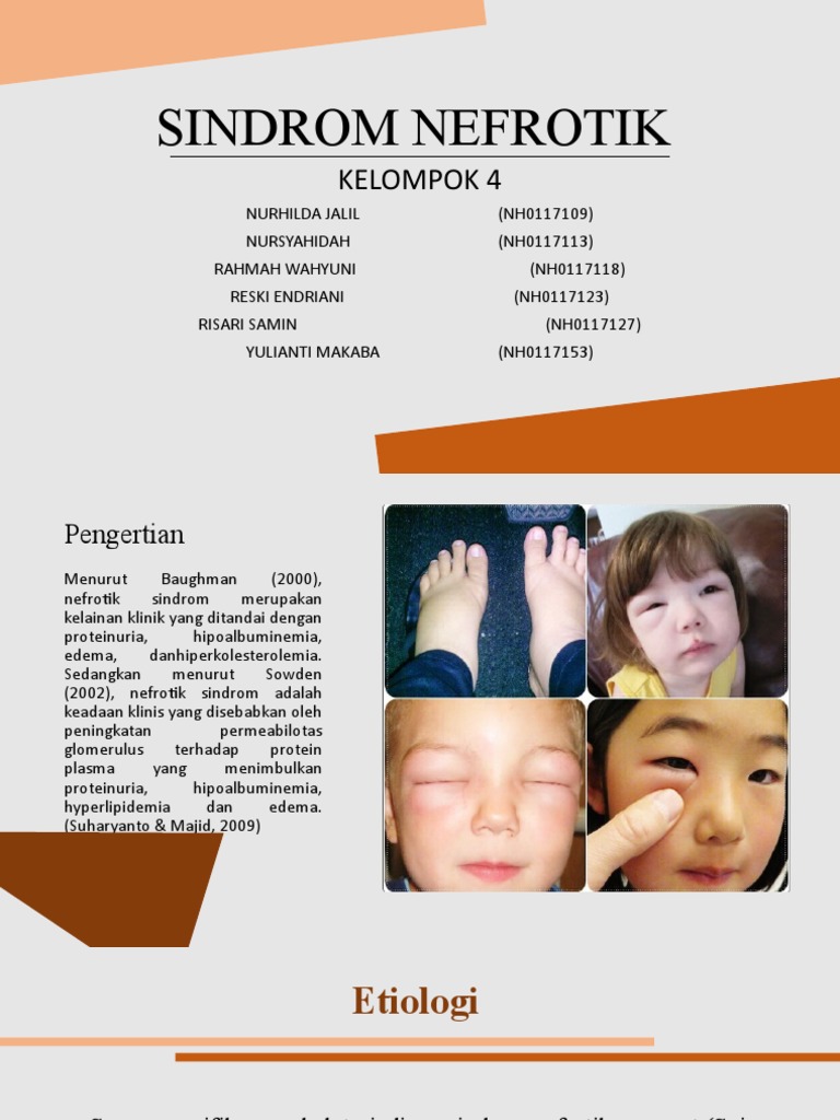 Sindrom Nefrotik | PDF | Kesehatan Holistik