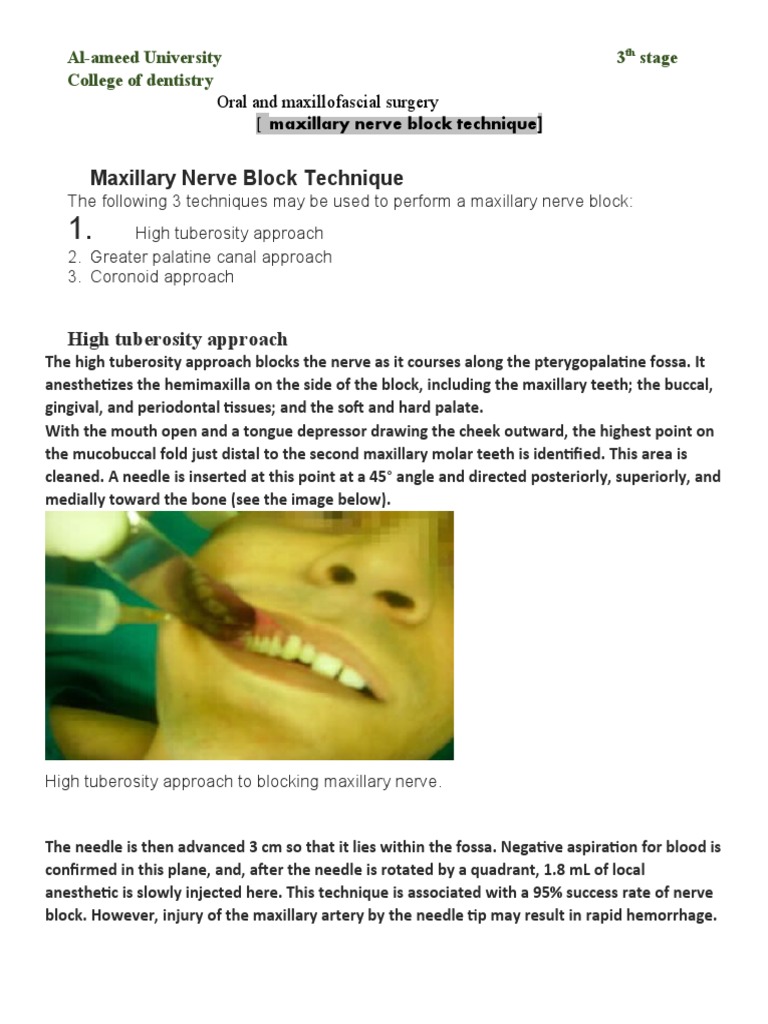 High Tuberosity Approach for Nerve Block | PDF | Paresthesia | Human ...