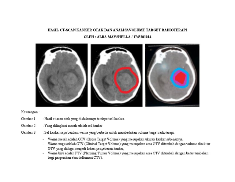 Hasil Ct-Scan Kanker Otak Dan Analisavolume Target Radioterapi OLEH ...