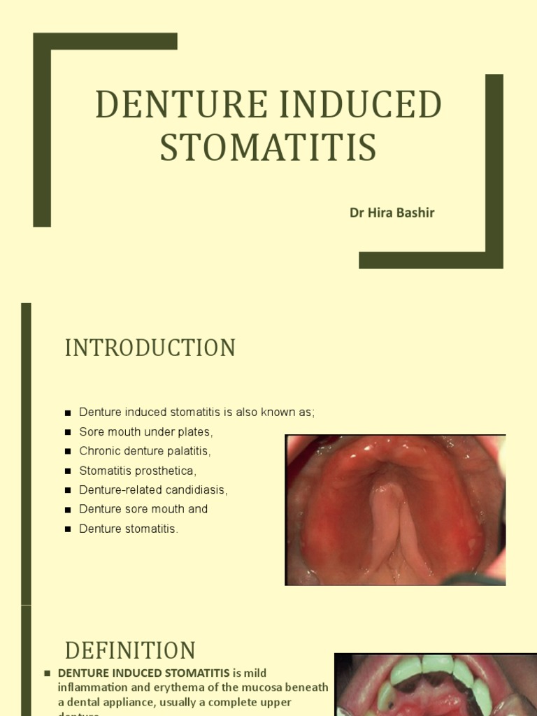 Denture Induced Stomatitis | PDF | Dentures | Medical Specialties