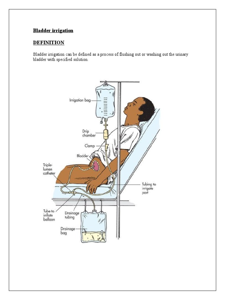 Bladder Irrigation | PDF | Urinary Bladder | Catheter