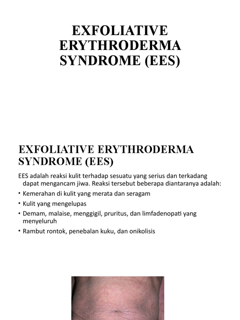 Exfoliative Erythroderma Syndrome (Ees) | PDF