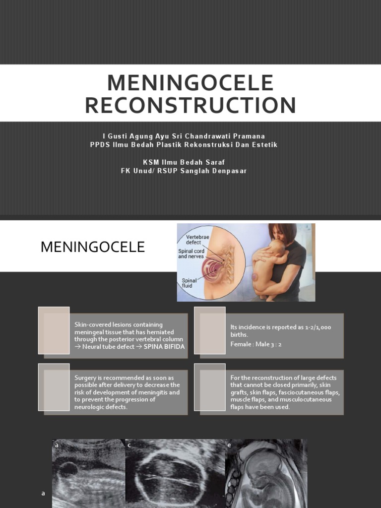 Meningocele Recon | PDF | Medical Specialties | Clinical Medicine