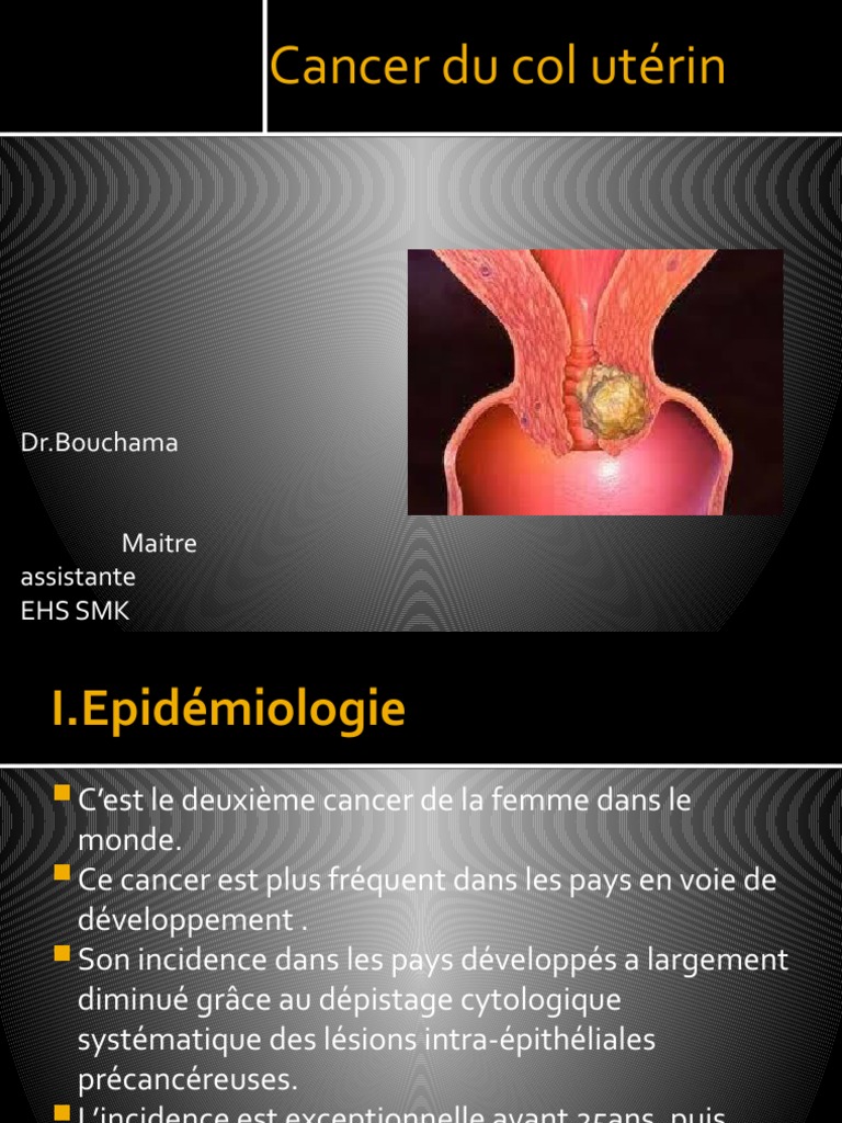 Cancer du col utérin : Épidémiologie et traitement | PDF | Cancer du ...