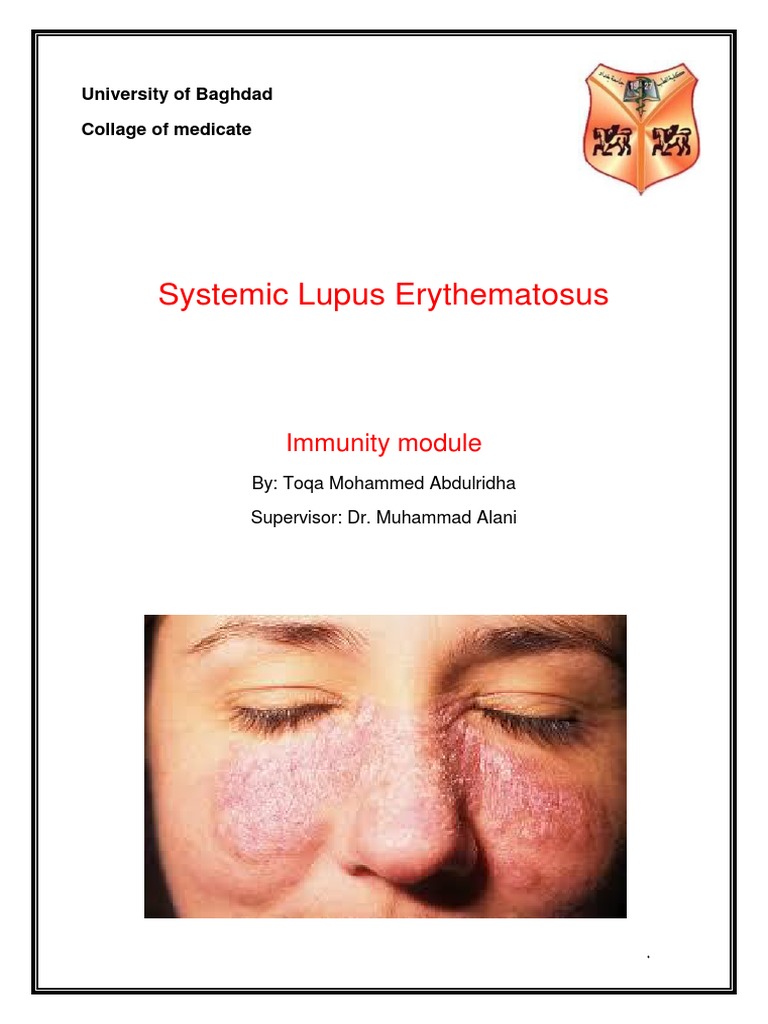 Systemic Lupus Erythematosus - Immunity PDF | PDF | Systemic Lupus Erythematosus | Innate Immune ...