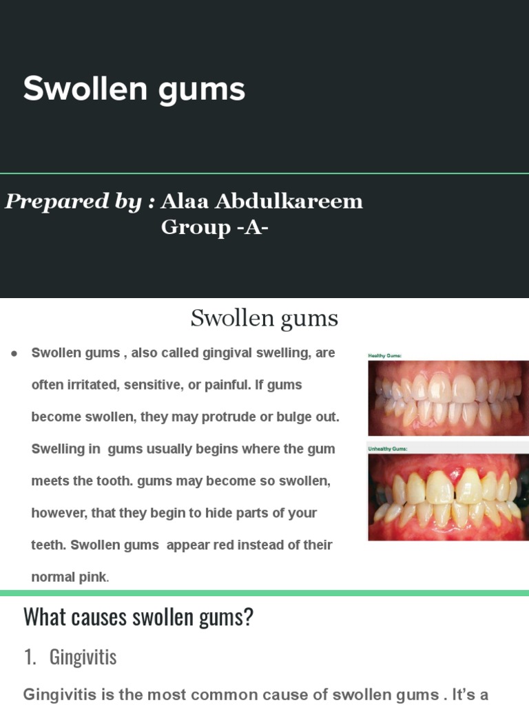 Swollen Gums: Prepared By: Alaa Abdulkareem | PDF | Edema | Diseases ...