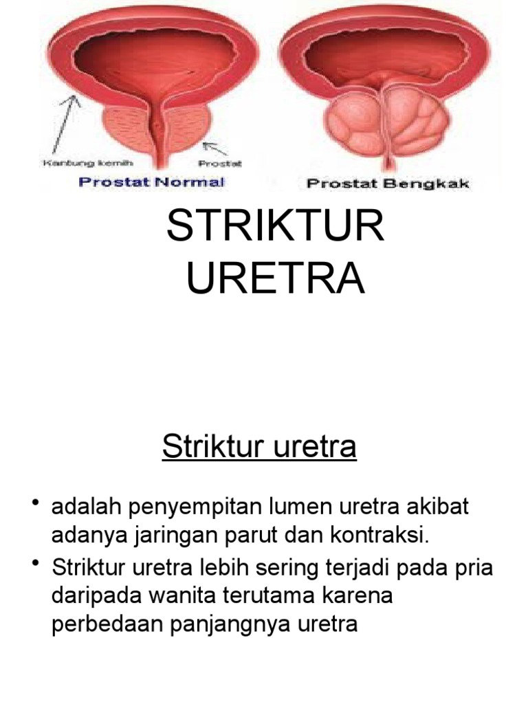 Penanganan Striktur Uretra pada Wanita | PDF