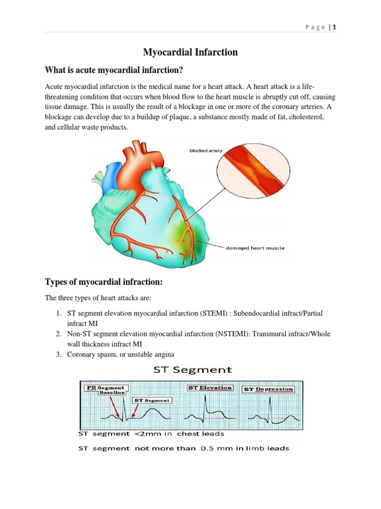 What Is Acute Myocardial Infarction? | PDF | Myocardial Infarction ...