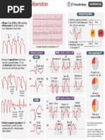 Left Anterior Fascicular Block (LAFB) - LITFL - ECG Library Diagnosis ...